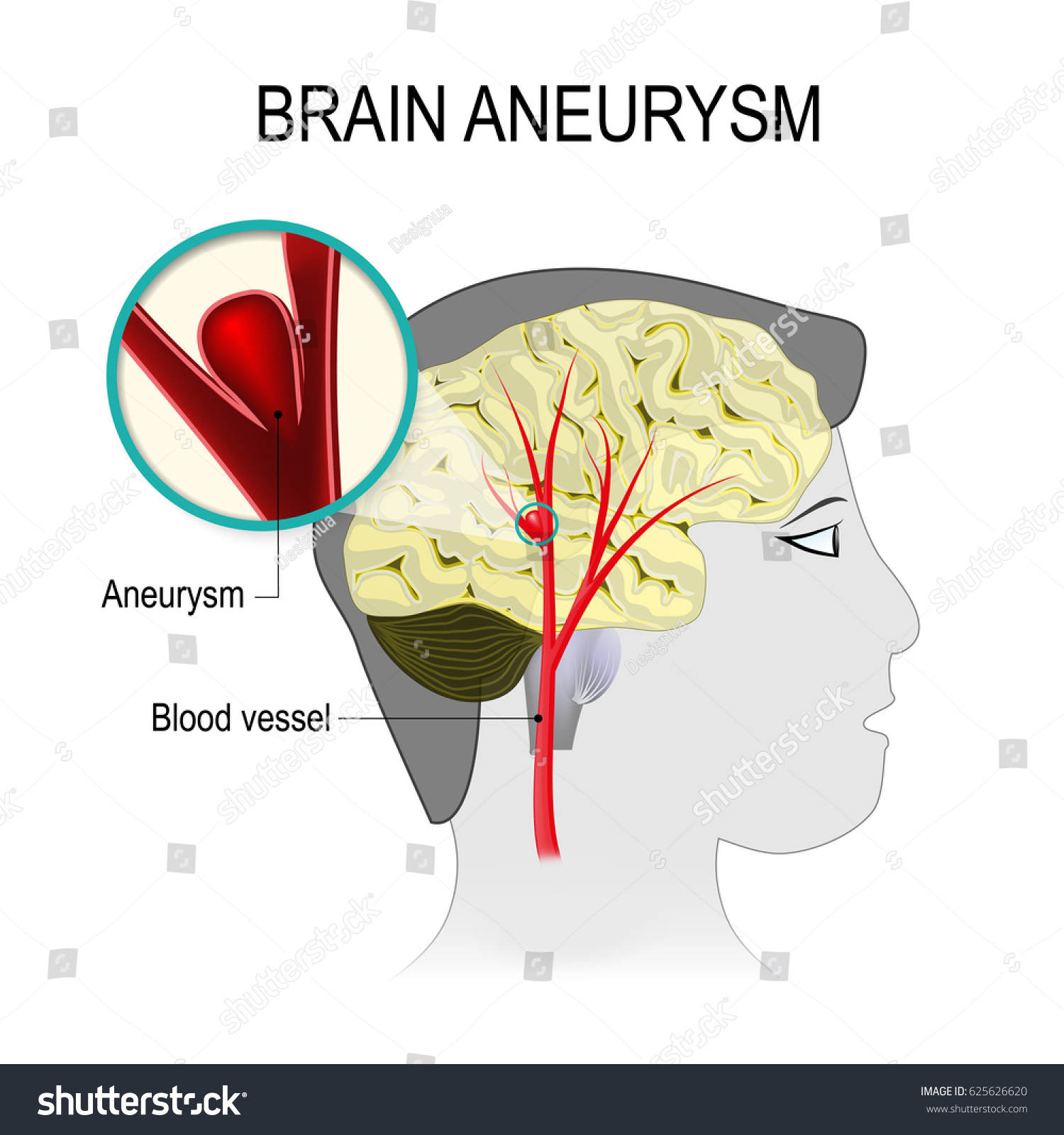🔥 [25+] Aneurysm Background | WallpaperSafari